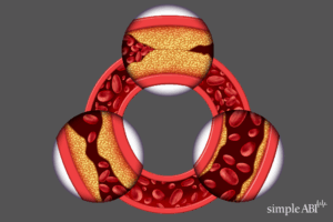 Peripheral Artery Disease Guidelines: Key Points